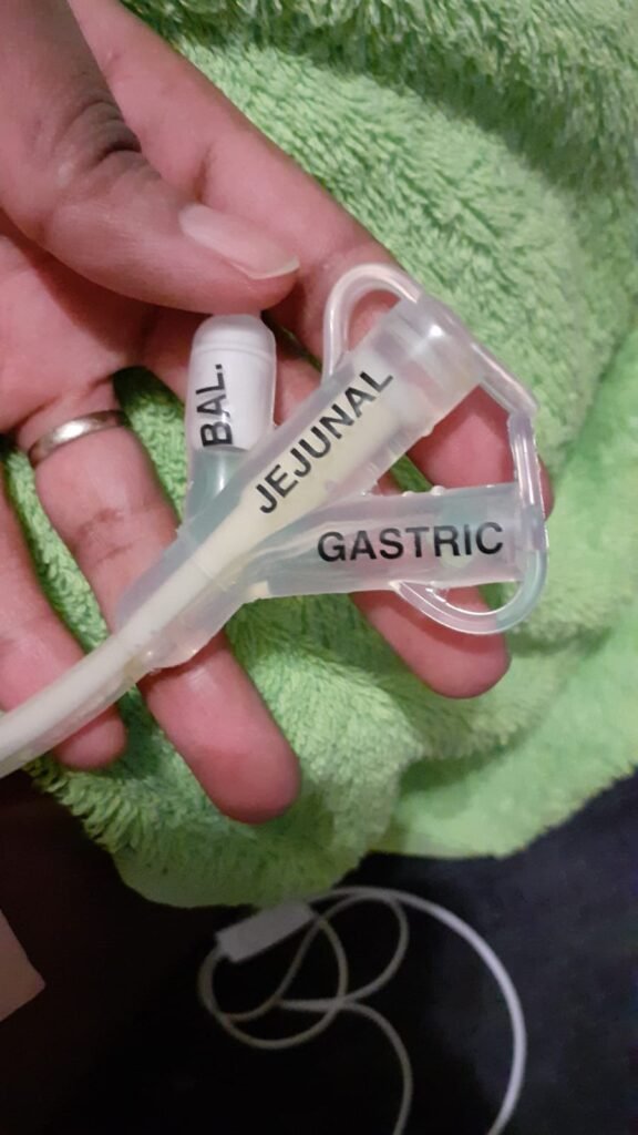 PEG Feeding Tube - Tube Feeding Support SA